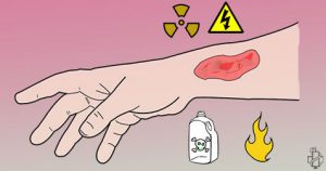 Opekotine i stepeni opekotina – Vatrozastita